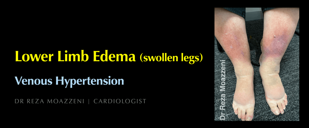 Severe Leg Edema Icd 10