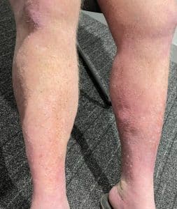 Unilateral Leg Swelling: Chronic Venous stasis vs Lymphedema