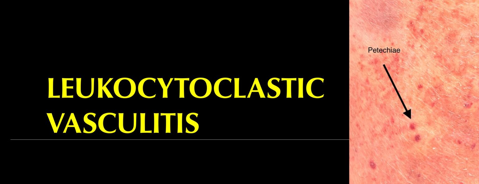 Amiodarone-induced Leukocytoclastic Vasculitis (LCV)